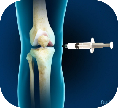 Facet Joint Syndrome - Regenerative Medicine | Solana Beach, CA